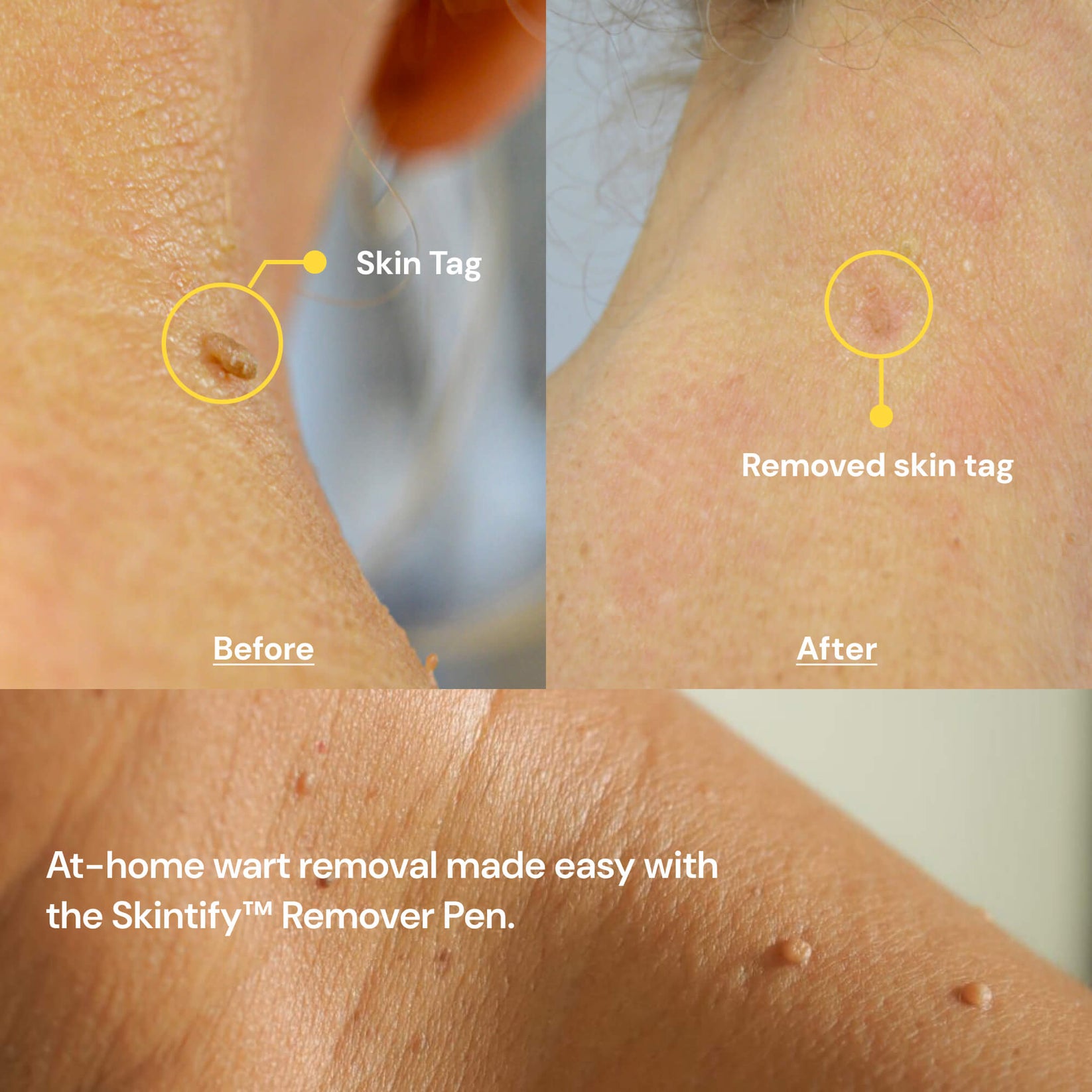 Skintify™ Remover Pen for Moles, Skin Tags, Warts, Age Spots, Freckles